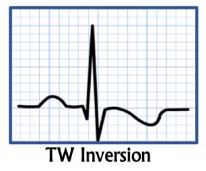 How to Read an EKG Rhythm Strip | Health And Willness