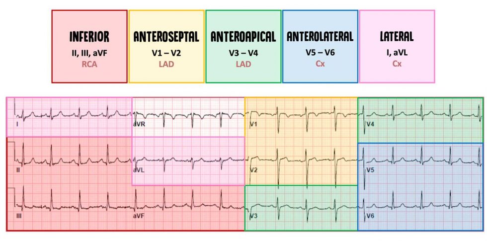 STEMI & NSTEMI: A Nurse’s Comprehensive Guide | Health And Willness