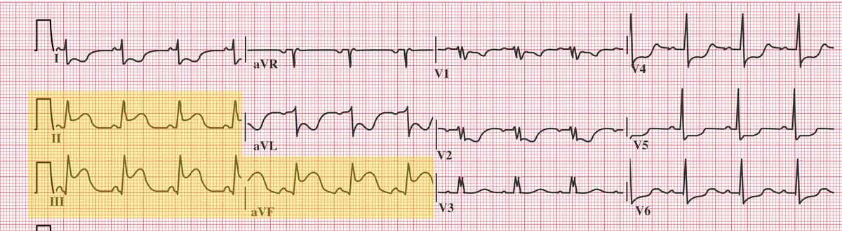 Stemi Location Chart